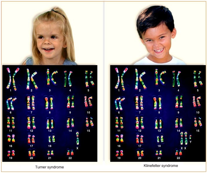 BIOLOGI GONZAGA: SYNDROME JACOBS - NON DISJUNCTION