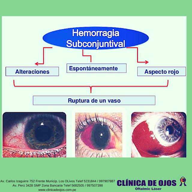 Clínica de Ojos Oftalmic Láser: HEMORRAGIA SUBCONJUNTIVAL