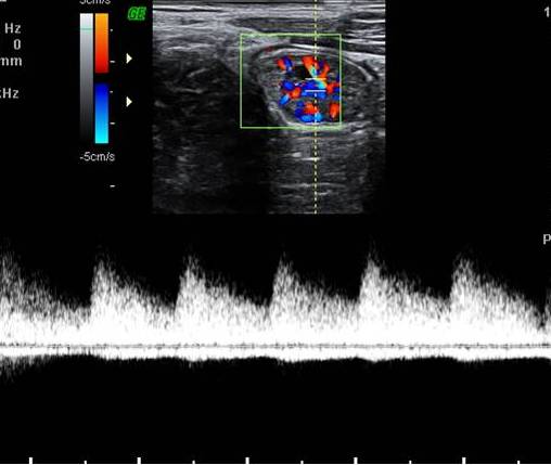 ‘DESCENDING COLONIC POLYP’- An ultrasound diagnosis - Sumer's Radiology ...
