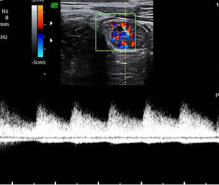 ‘DESCENDING COLONIC POLYP’- An ultrasound diagnosis - Sumer's Radiology ...