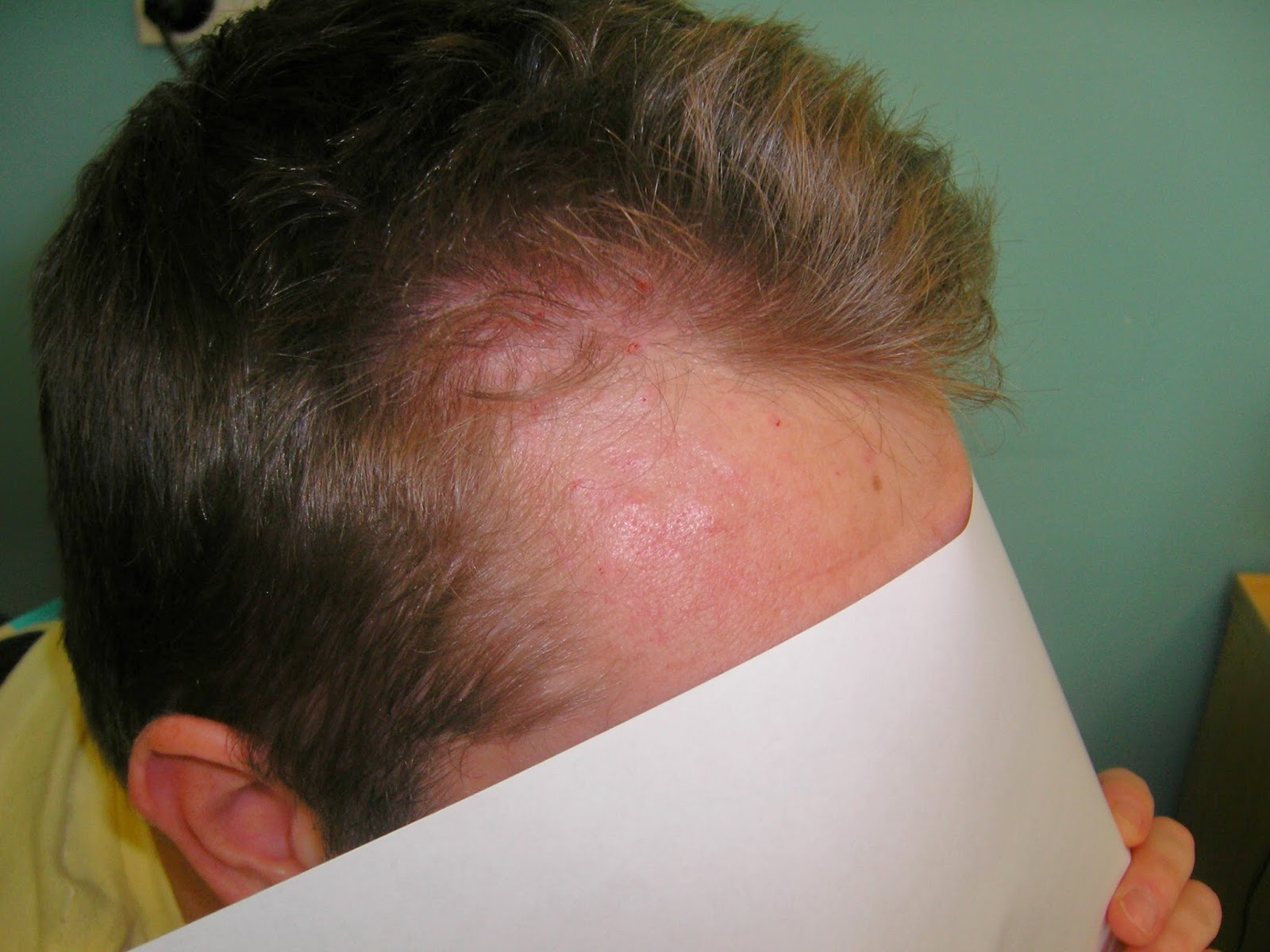 Hyperhidrosis Sydney: I cant stop sweating from my forehead. There is a ...