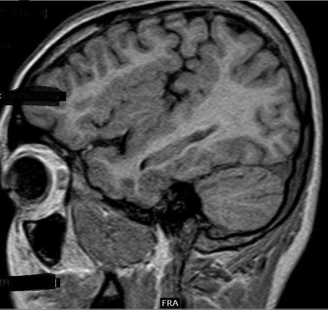 Polymicrogyria-Teaching Points - Sumer's Radiology Blog