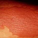 For Our Health: Neurodermatitis (scratching localized dermatitis ...