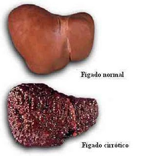 Efeitos do Álcool no Metabolismo: Vejam a diferença entre o fígado ...