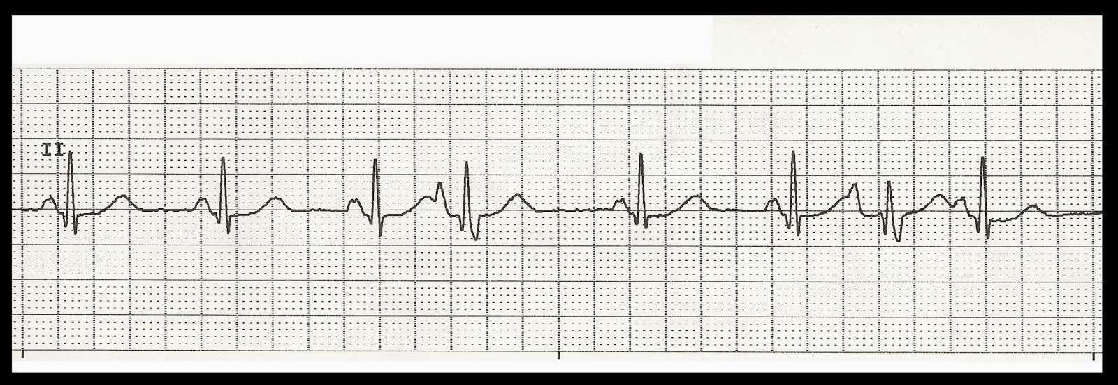 EKG Rhythm Strip Quiz 211