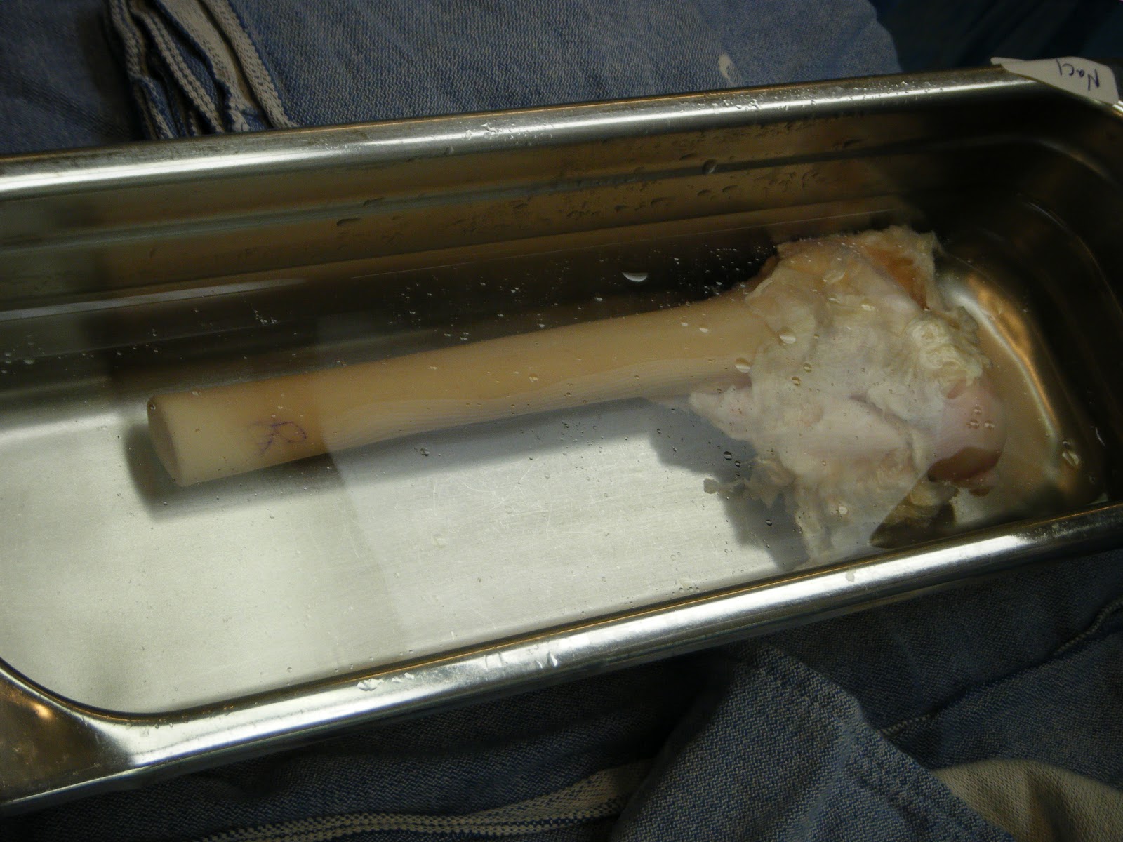Bone grafting | The Ultimate Curiosity