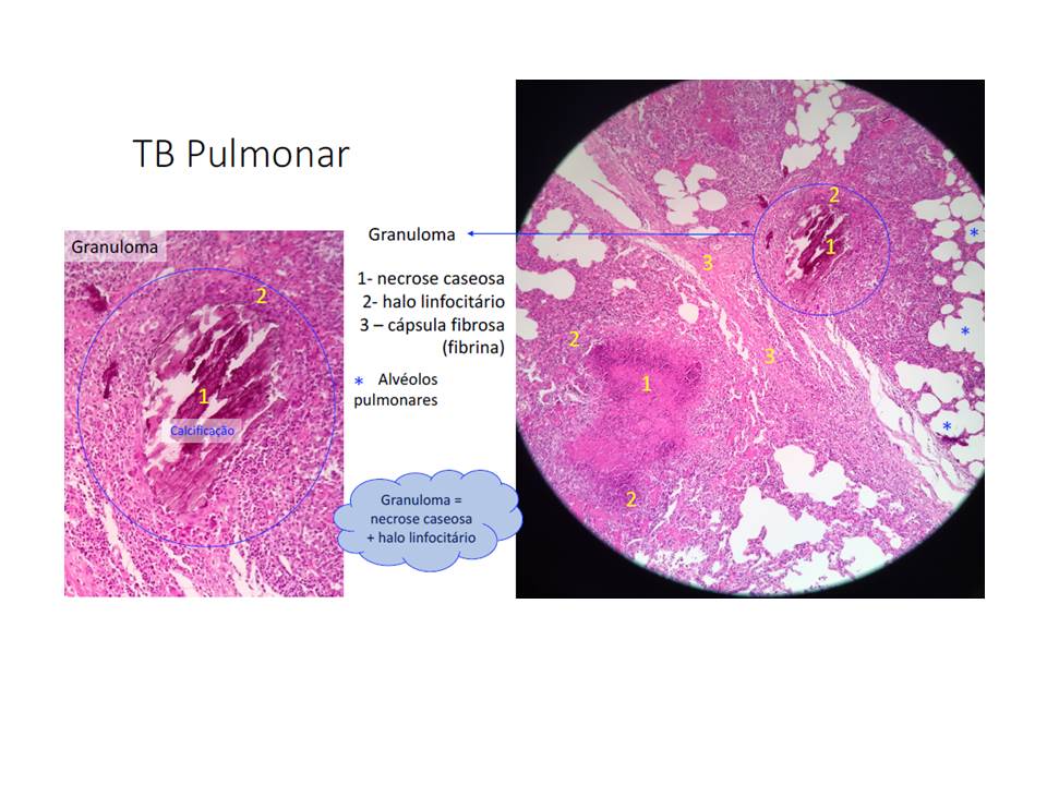 HISTOLOGIA90: TIPOS DE NECROSE
