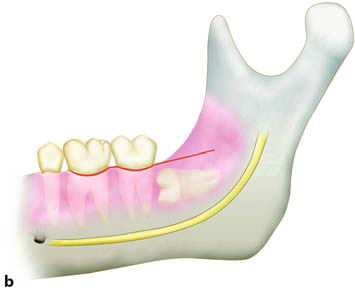 Dentistry and Medicine: Impacted Mandibular 3rd Molar Classification ...