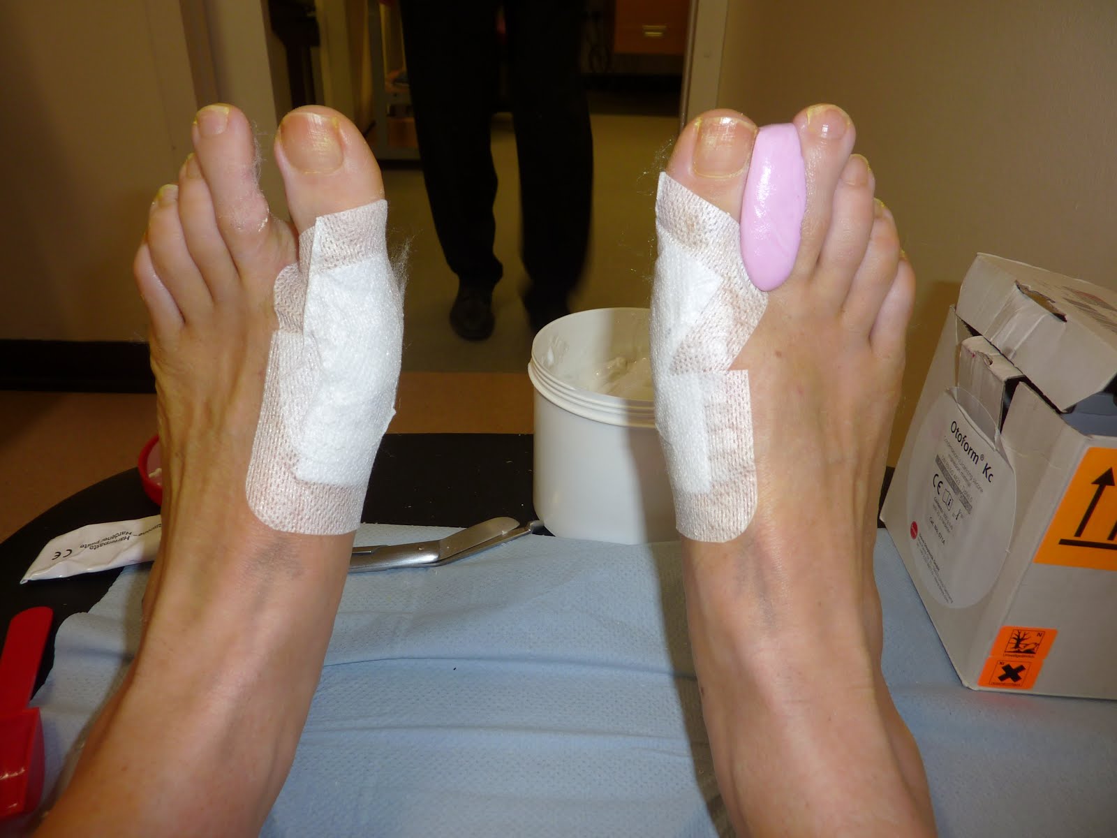 From bunions to beautiful feet: The big reveal! Sort of. With pictures.