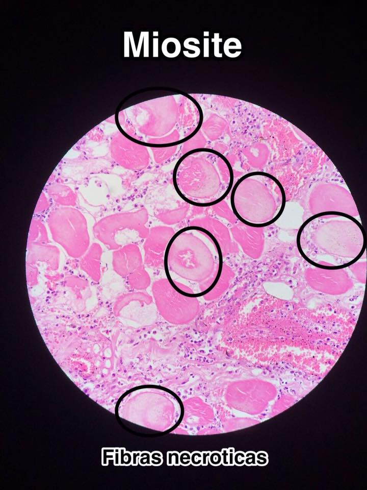 HISTOLOGIA90: MIOSITE