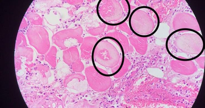 HISTOLOGIA90: MIOSITE