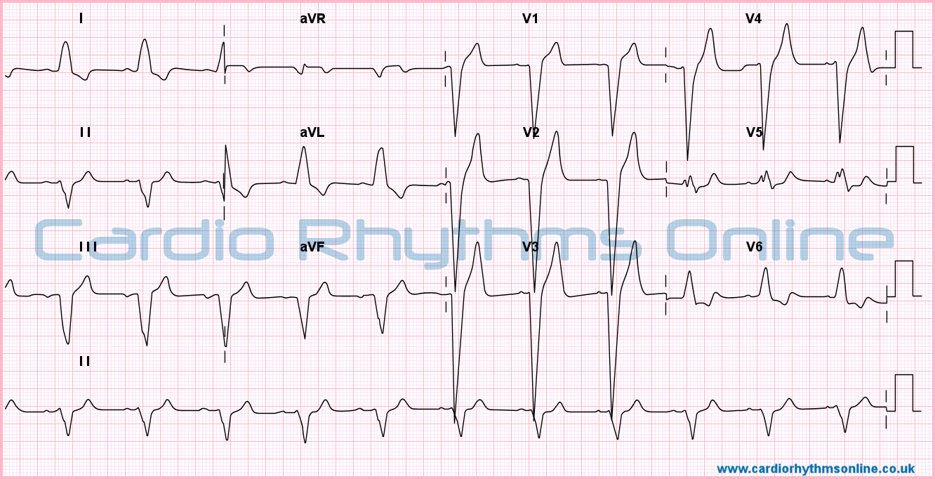 Cardio Rhythms Online: Ventricular Conduction Disturbances