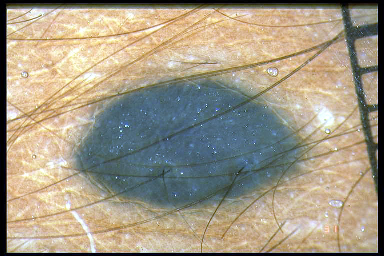 Neo bluastro con bordi rossi: è melanoma?