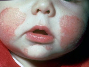 Contact dermatitis lips