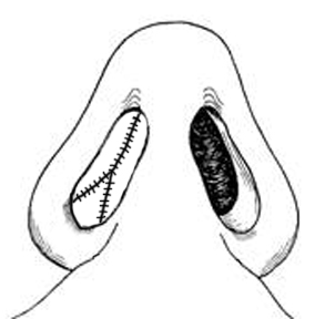 The Recurrent Recurrent Nosebleed Treatment - Sewing the Nostril Shut ...
