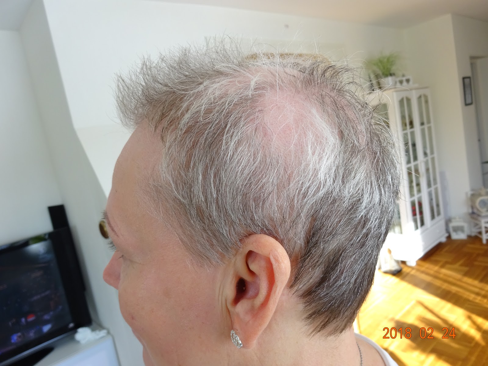 MITT LIV MED ALOPECI - ALOPECIA: MITT ÄLSKADE HÅR LOSSNAR - IGEN!!!