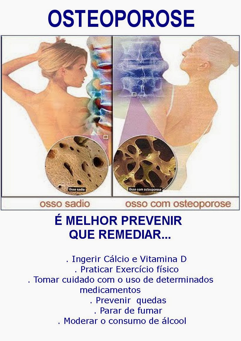 Osteoporose ? O que é e como a poderemos prevenir...
