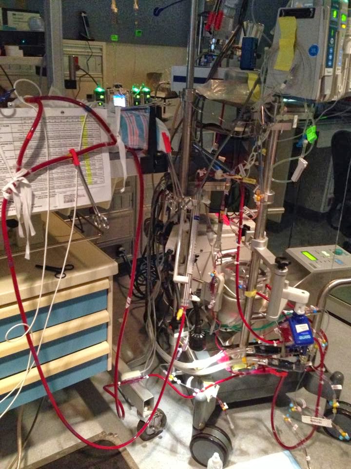 Our CDH Journey: ECMO