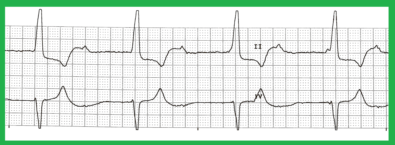 Practice Rhythm Strips 264