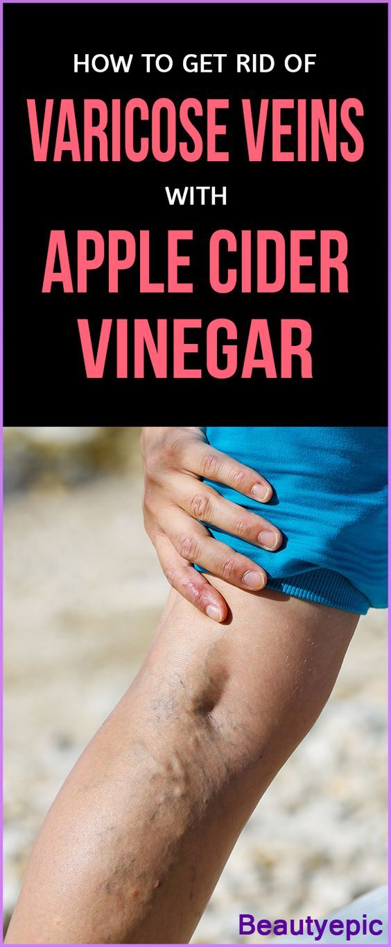 How To Use Apple Cider Vinegar For Varicose Veins Natural Health