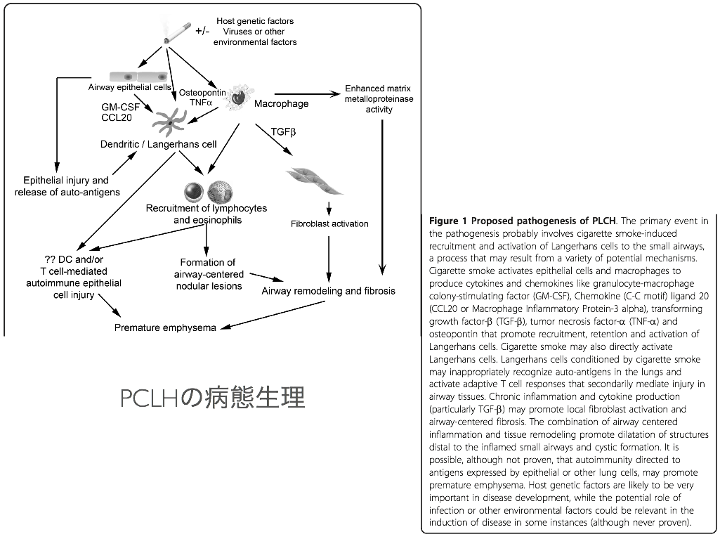 Hospitalist ~なんでも無い科医の勉強ノート~: Langerhans Cell Histiocytosis(LCH) ラングハンス ...