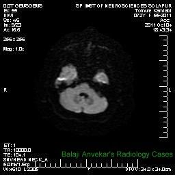 Dr Balaji Anvekar FRCR: Artifact on MRI Diffusion