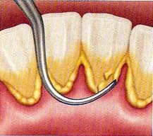 AB Saúde: Entenda o que é e como evitar tártaro e placa bacteriana