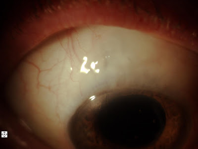 Sonoran Desert Eye Center: BLEB FROM TRABECULECTOMY