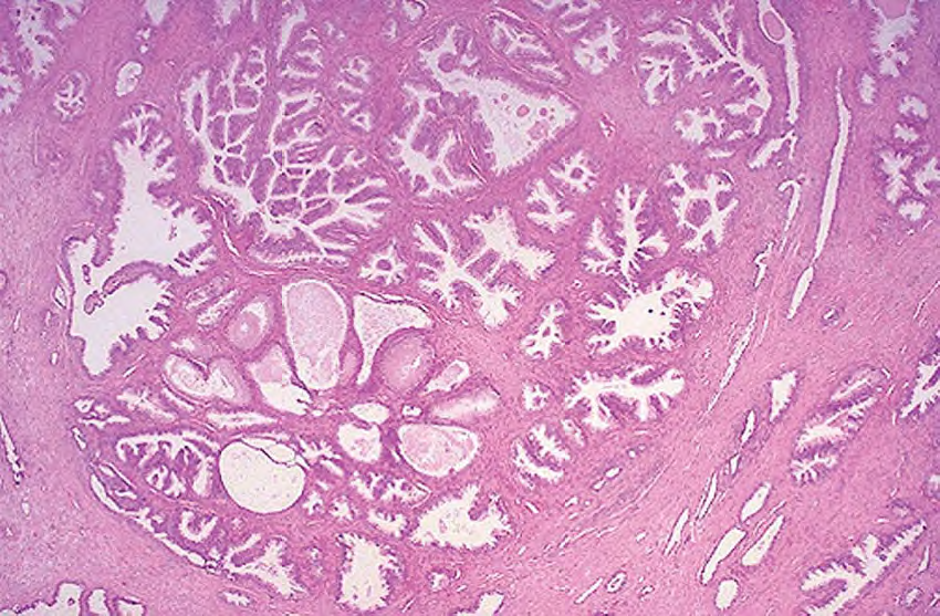 Histopatología: PATOLOGIA DE LA PROSTATA