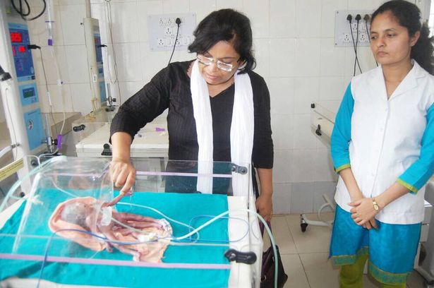 Latest Updates: Baby girl born with two torsos, four arms and four legs