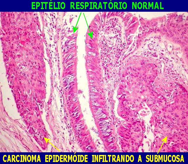 Epidermoide