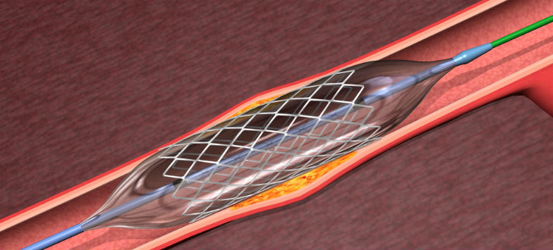 Vou Precisar Colocar Um Stent. E Agora? - Saúde & Conhecimento