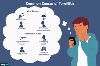 Tonsillitis and Its Pathophysiology ~ Pharmacy Portal