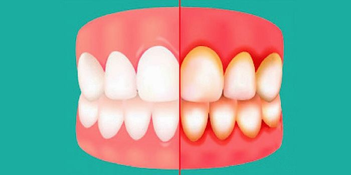 ¿Cómo prevenir y tratar la gingivitis del embarazo? - OdontoVida