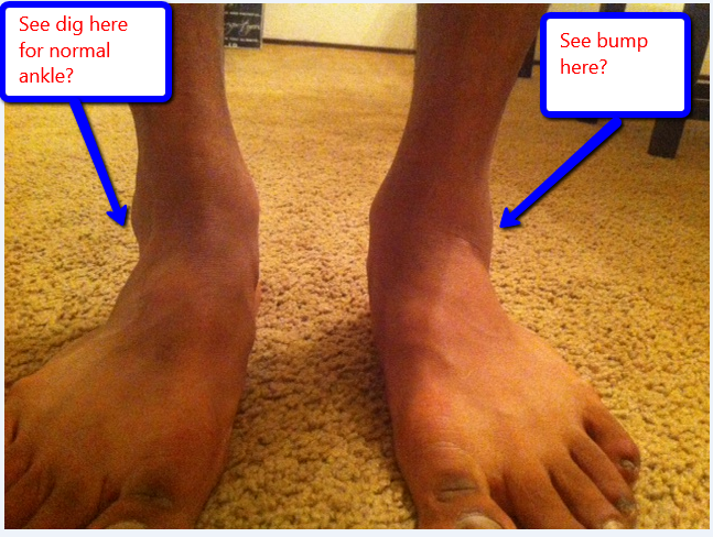 RunningAHEAD - Topic: Ankle roll and swelling