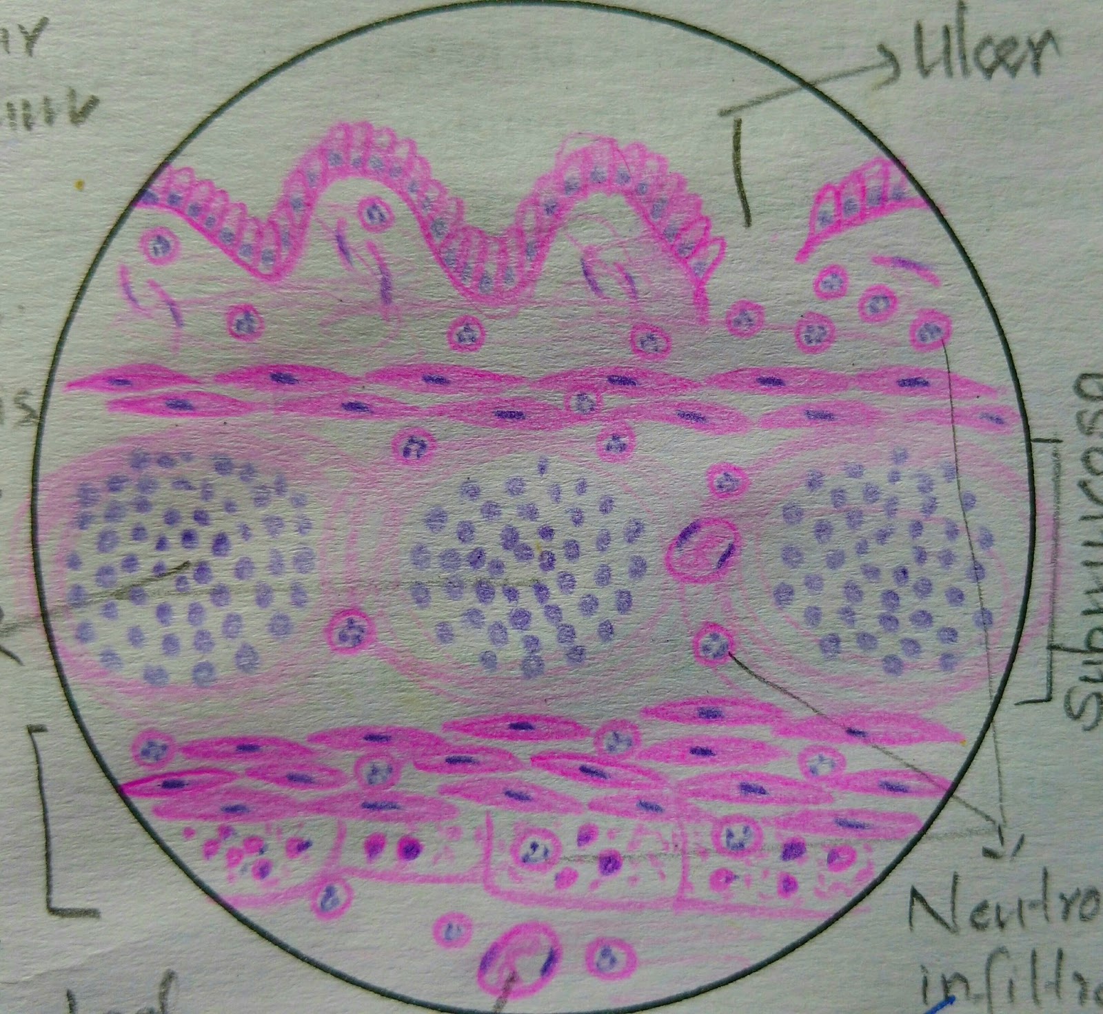 Histopathology Drawings: Acute appendicitis