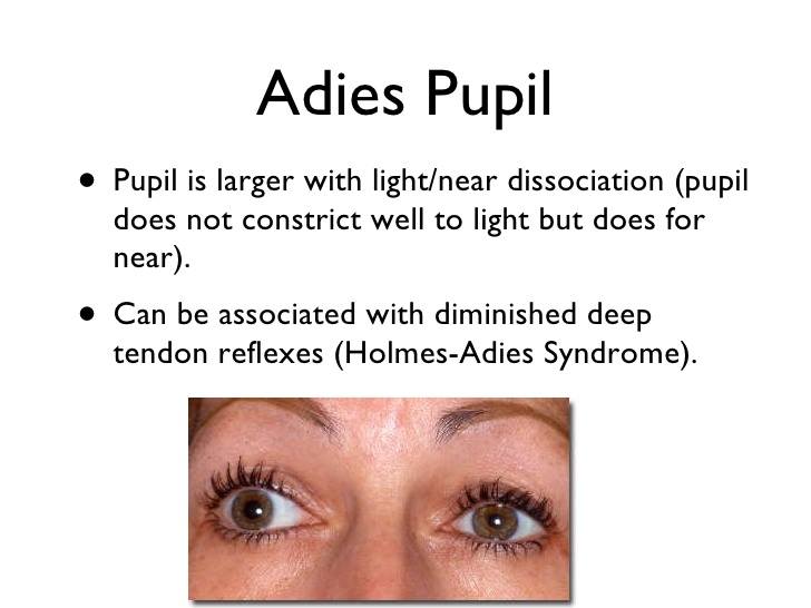 Adie syndrome