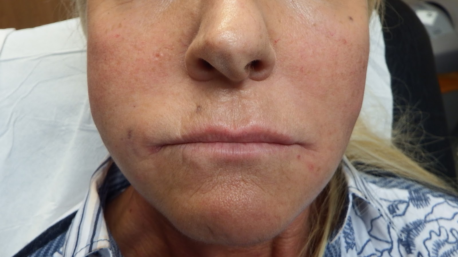 Selston Cosmetic Clinic: Smoother Tighter Face with PDO Thread Lifts ...