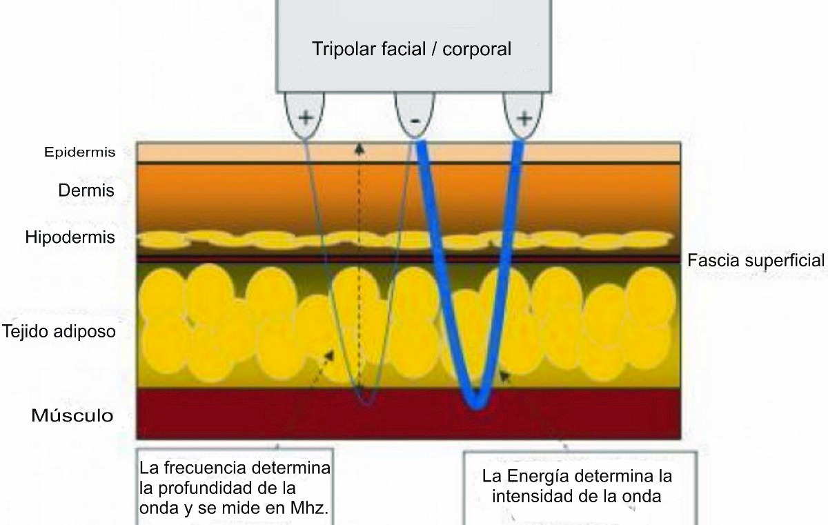 Derma Beauty: Piel firme y abdomen plano con Radiofrecuencia Tripolar