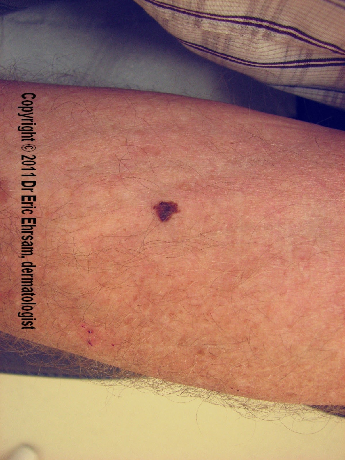 dermoscopy: Emerging on a forearm