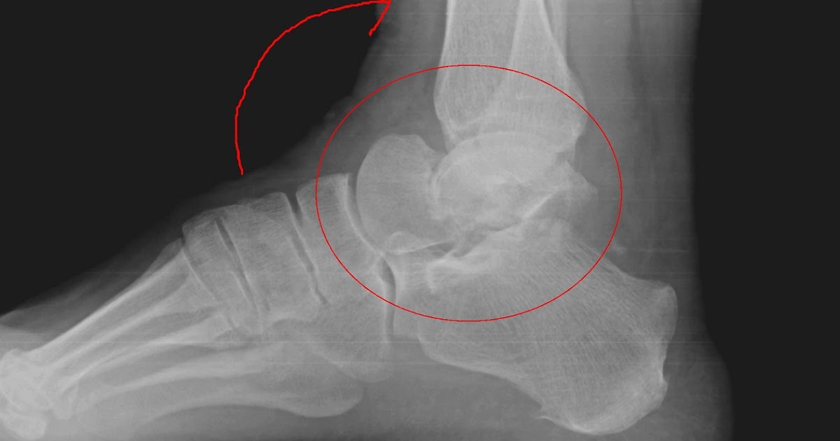 Dr. K. Lam Straight Talk: Talus fracture : Personal Injuries #PI common ...