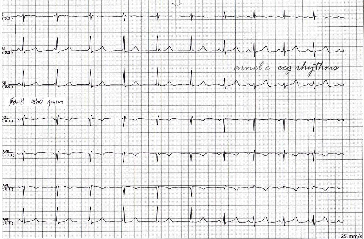 ECG Rhythms: Utilizing QRS Morphology in Deciphering Rhythms