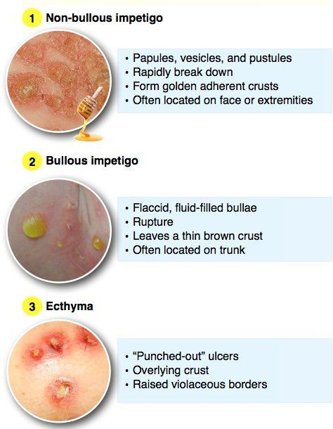 Impetigo
