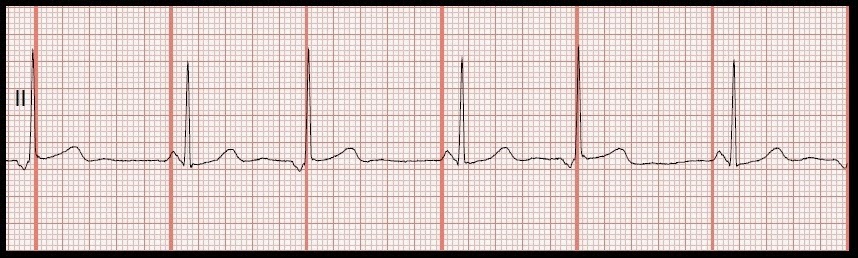 EKG Rhythm Strip Quiz 203