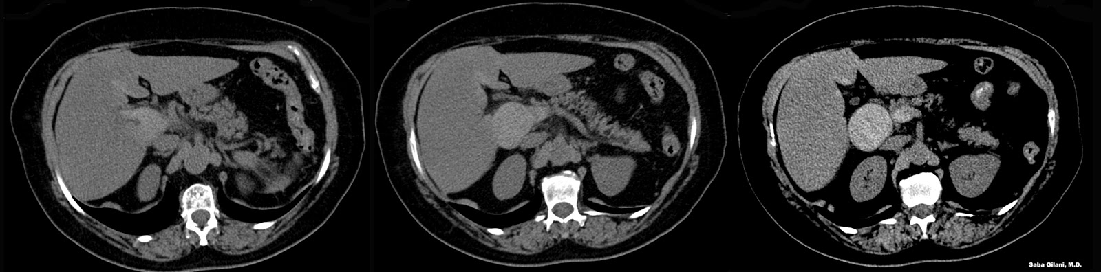 Roentgen Ray Reader: Portal Vein Varix
