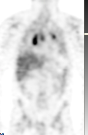 NuCleaR MuNkeE: Sarcoid versus Scleroderma