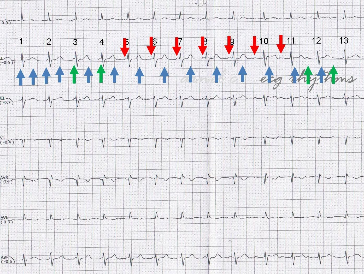ECG Rhythms: Atrial tachycardia with a block vs. AFl with Wenckebach