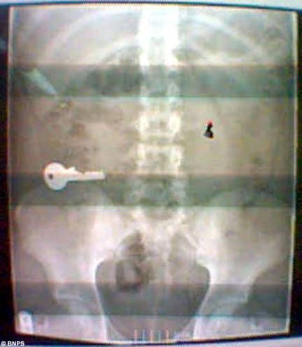 Art-Sci: Gulp! Swallowed Objects Revealed by X Rays