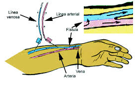Enfermer@ en Urgencias y UCI : Punción de la Fístula Arterio – Venosa ...