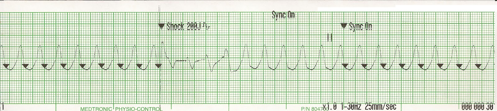 Megacode: Unstable Ventricular Tachycardia Part 4